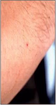 Maladie de Lyme | Agence régionale de santé Auvergne-Rhône-Alpes